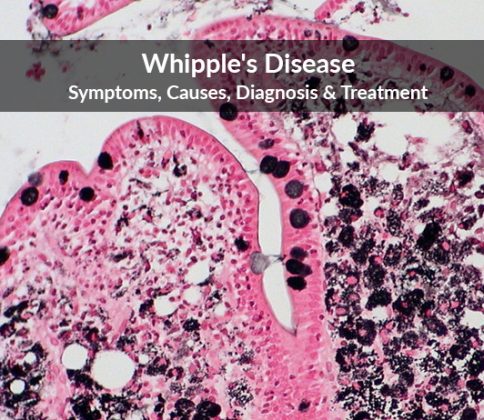 Whipple’s Disease: Symptoms, Causes, Diagnosis & Treatment